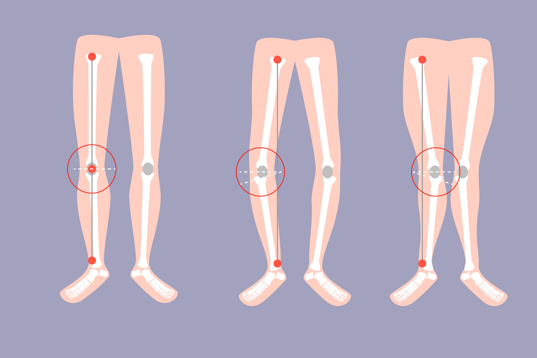 Rodillas Valgo y Varo - Clínica de Fisioterapia en Guatemala